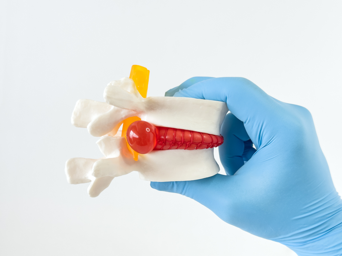In Depth Research Of Disc Protrusion Herniated Disc Sciatica Cortisone Injection And Disc