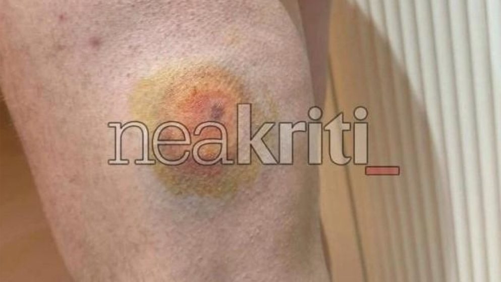 Καταγγελίες για χρήση πλαστικών σφαιρών από τα ΜΑΤ στα επεισόδια του ...